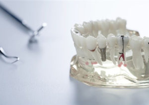 Rotfylling – Fonna Tannklinikk